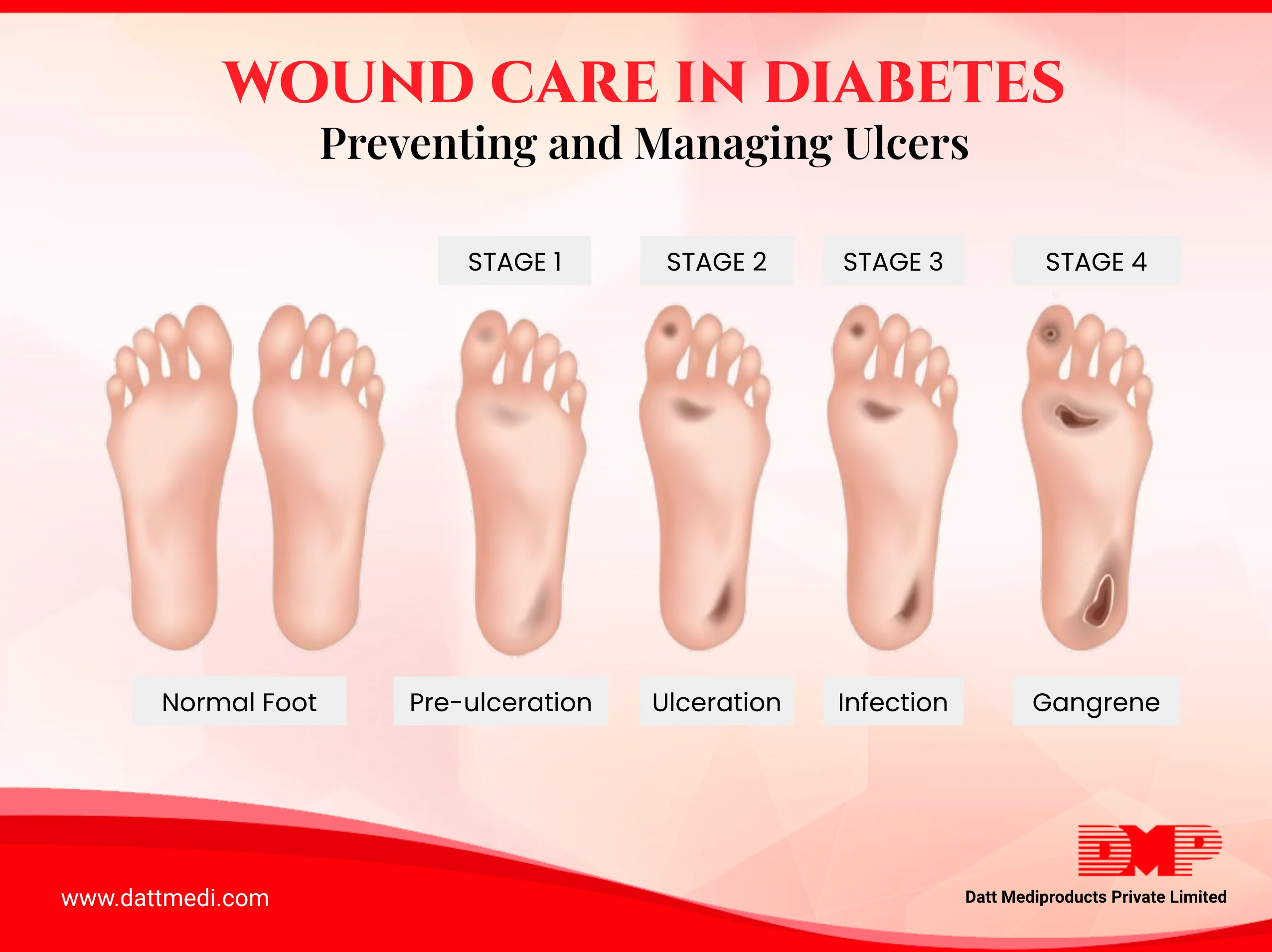 Diabetic Foot Ulcer Care: Prevention & Healing Guide